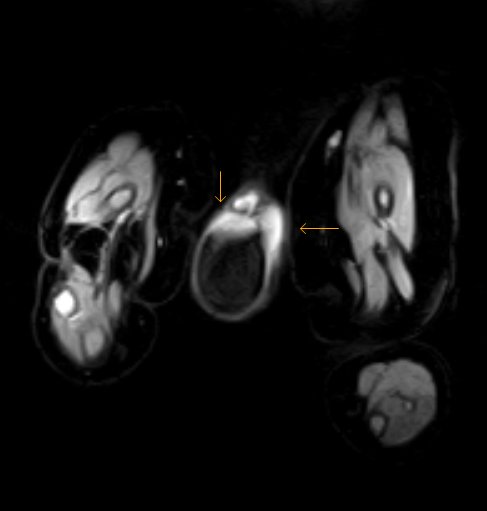 Scrotal Lipoma-MRI - Sumer's Radiology Blog