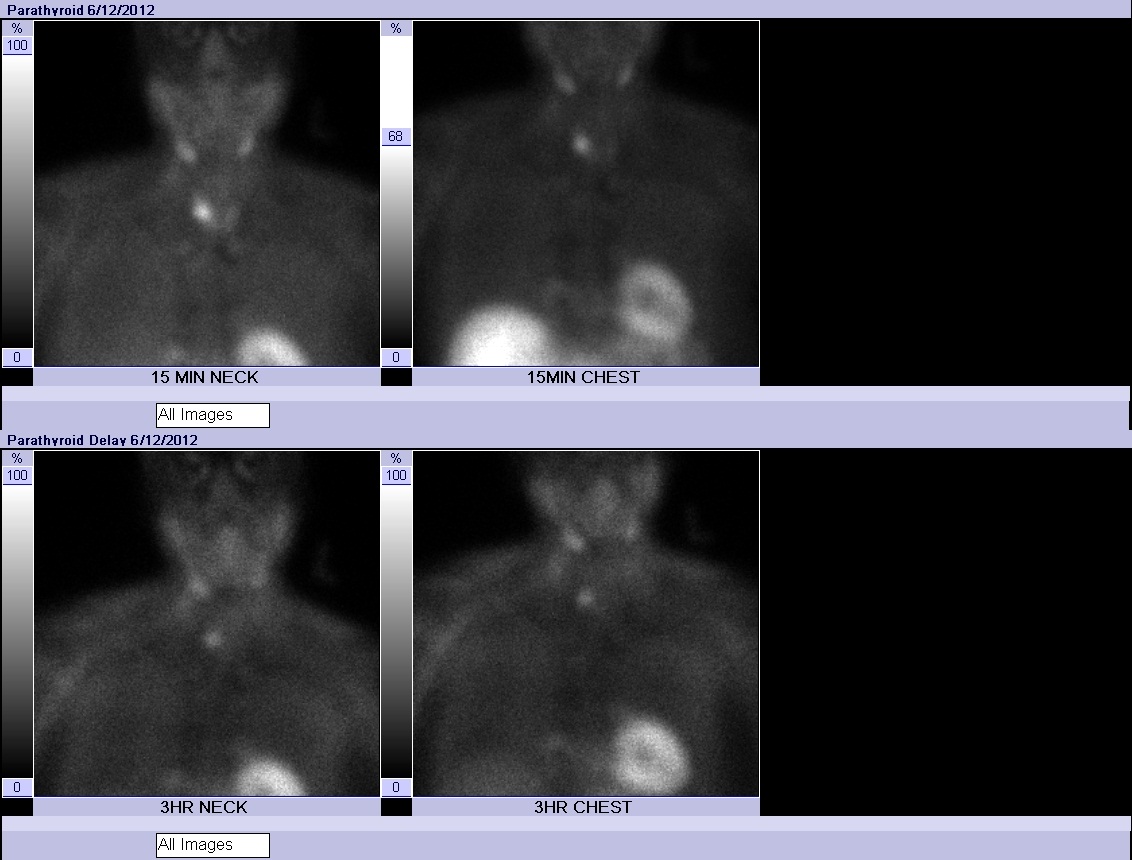 Nuclear Medicine Technology Program: Abnormal Parathyroid Scan