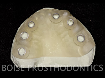 Boise Idaho Prosthodontics: Maxillary Implant Rehab Provisional, Index ...