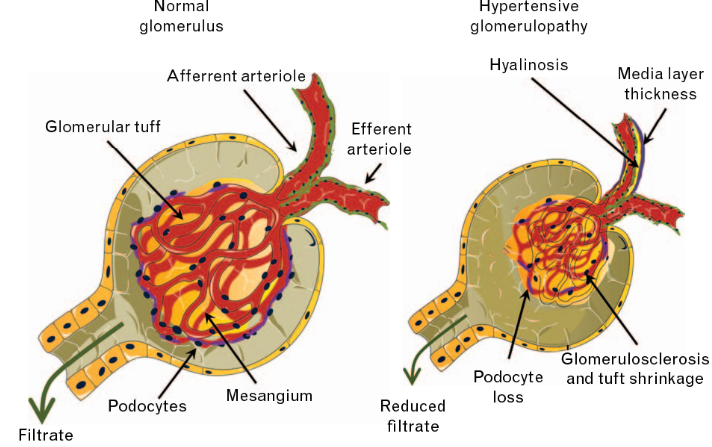 Perkhidmatan buah pinggang China: Apakah maksud Nephropathy hipertensi