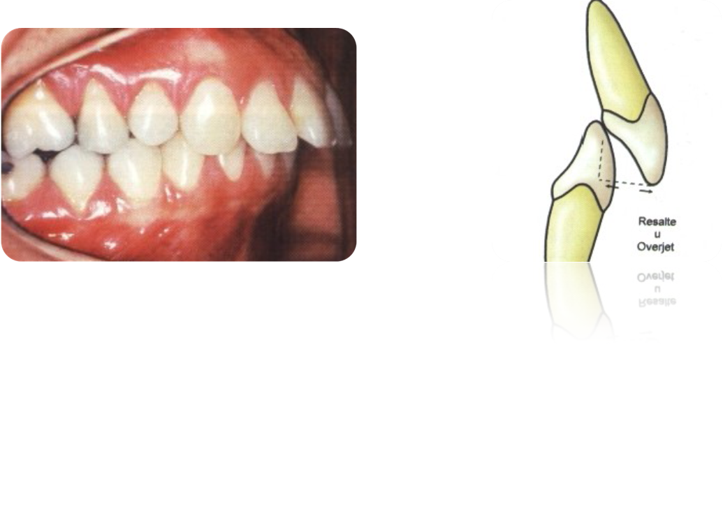 MALOCLUSIONES CLASE II