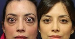 Semiología Y Salud: ANOMALÍAS DE OJO