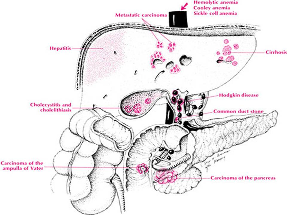 HeaLtH: Ikterus