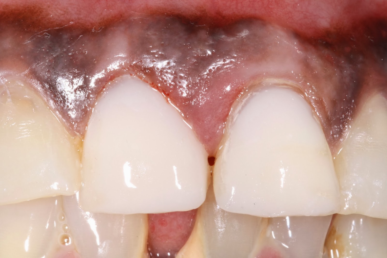 Crescent Dental on Blogspot!: Extreme Acid Tooth Erosion Due to Lemon ...
