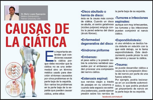 CIATICA: METODOS PARA REDUCIR EL DOLOR DE CIATICA