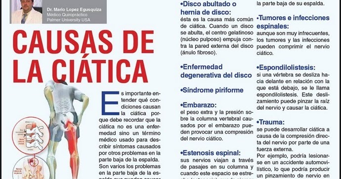 Guía sanitaria: Causas de la ciática
