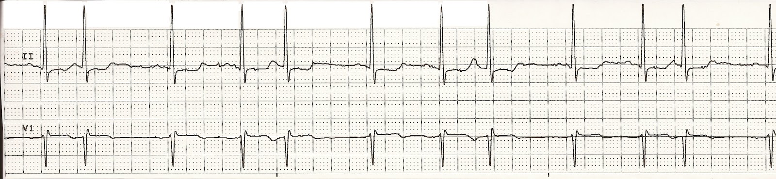 Float Nurse: EKG Rhythm Strip Quiz 44