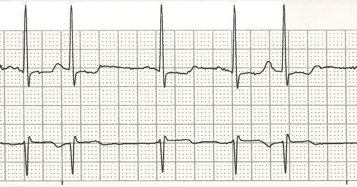 EKG Rhythm Strip Quiz 44