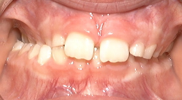 Truman Orthodontics: Unilateral Crossbite With a Functional Shift
