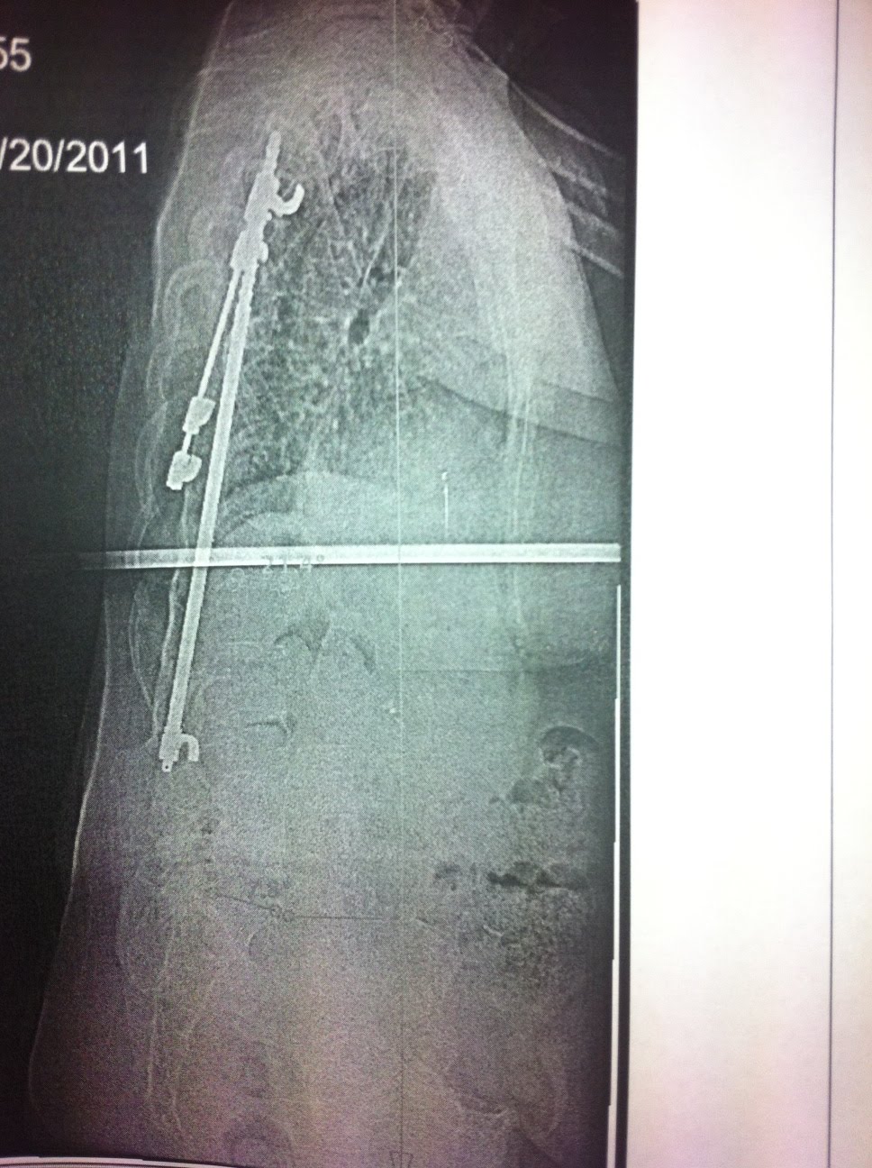 Flat back syndrome fix for today - Hey Clinic