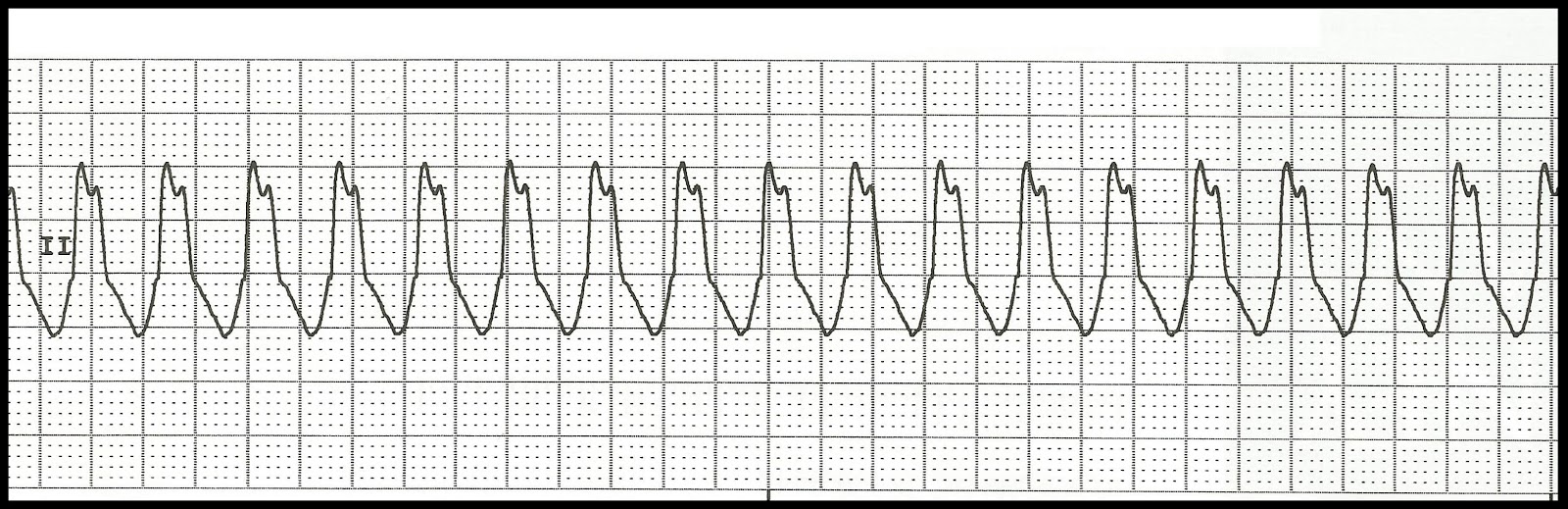 Practice EKG Rhythm Strips 177