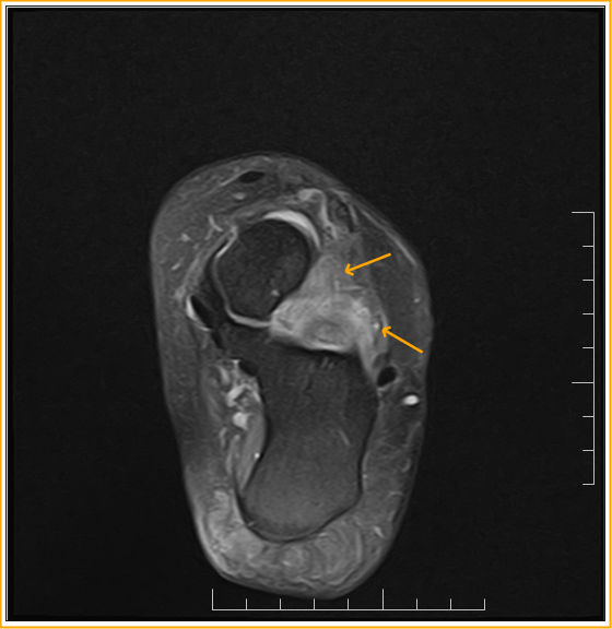 Sinus Tarsi Syndrome : MRI - Sumer's Radiology Blog