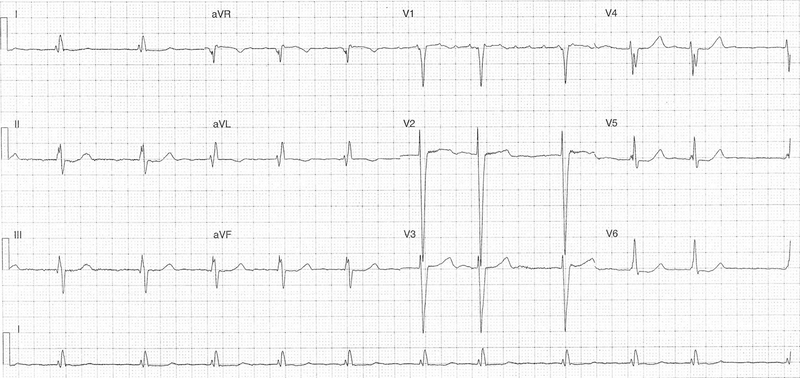 ECG of the Week: ECG of the Week - 18th December 2017 - Interpretation