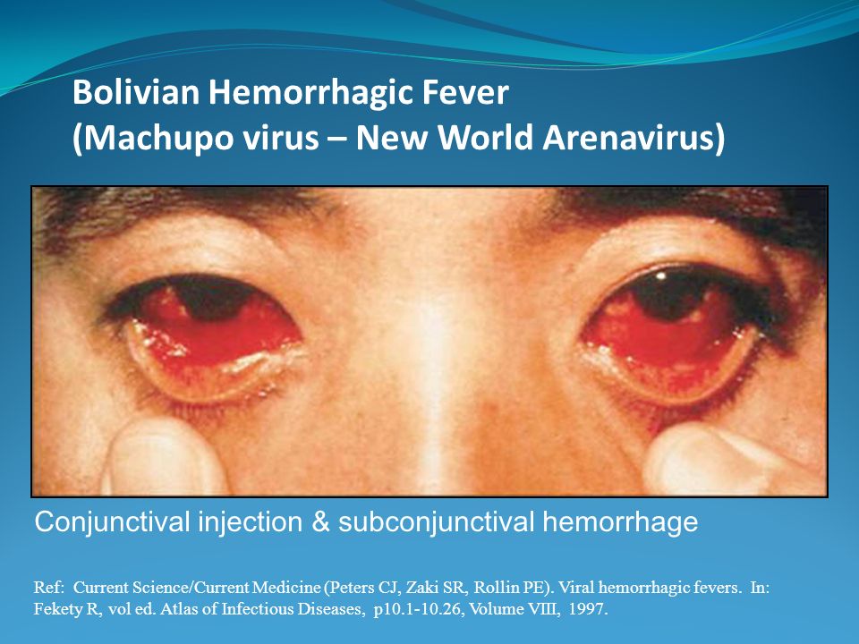 Vírus Machupo - FHB : História,Epidemiologia,Patogenicidade,Transmissão ...