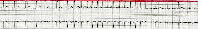 ECG Channel: Atrial Tachycardia