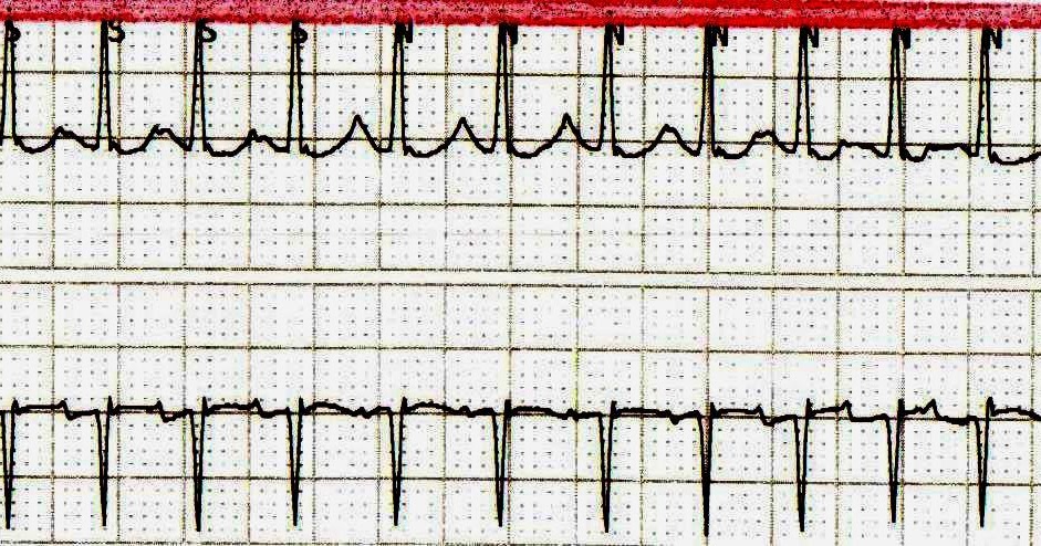 ECG Channel: Atrial Tachycardia