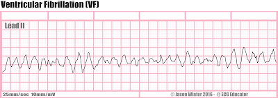 ECG Educator Blog : Six Second ECG Rhythm Strips