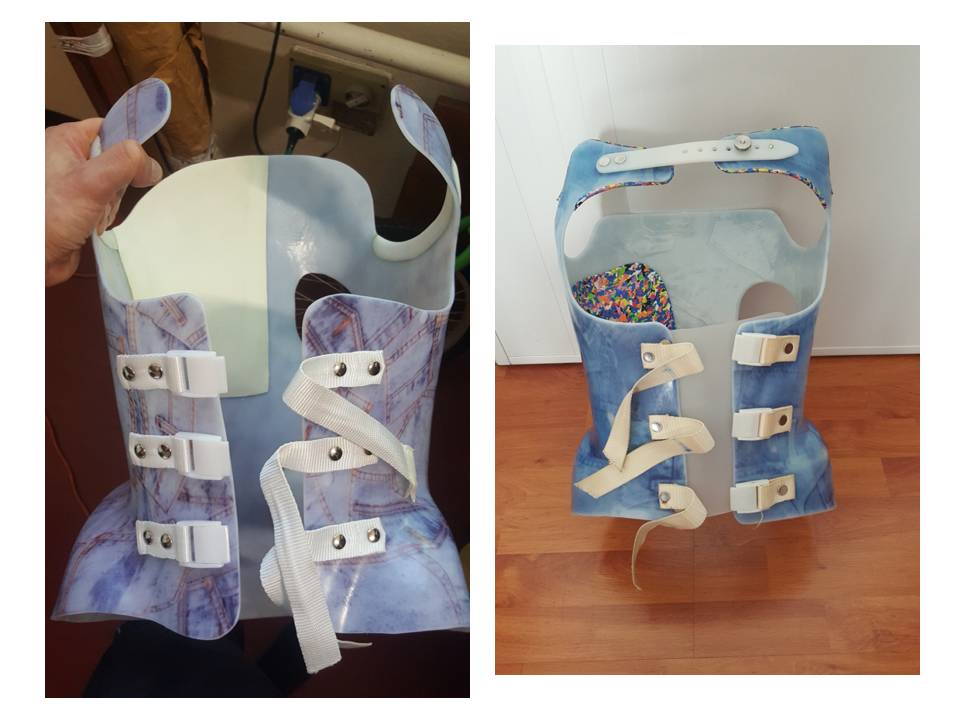 Despre corsetul Cheneau :: Corset scolioza / scoliosis braces