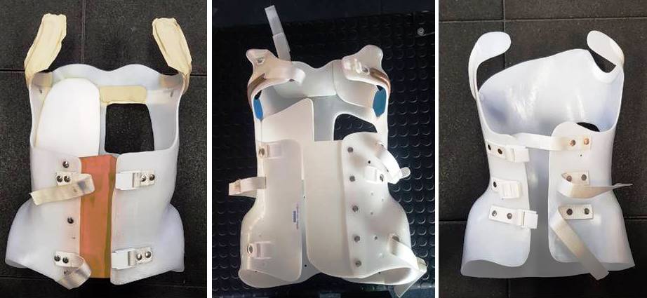 Despre corsetul Cheneau :: Corset scolioza / scoliosis braces