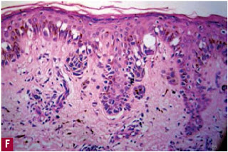 PUBLIC HEALTH: TUMOR MELANOCYTIC; Congenital Nevomelanocytic Nevus ...