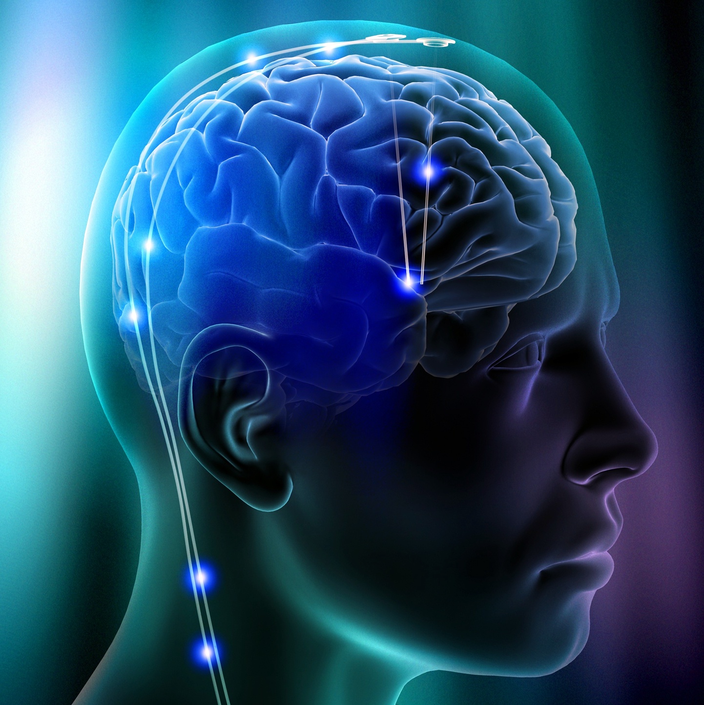 Maladie de Parkinson: la Neurostimulation 'Stimulation Cérébral ...