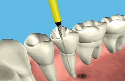 Removable Partial Denture: Root Canal