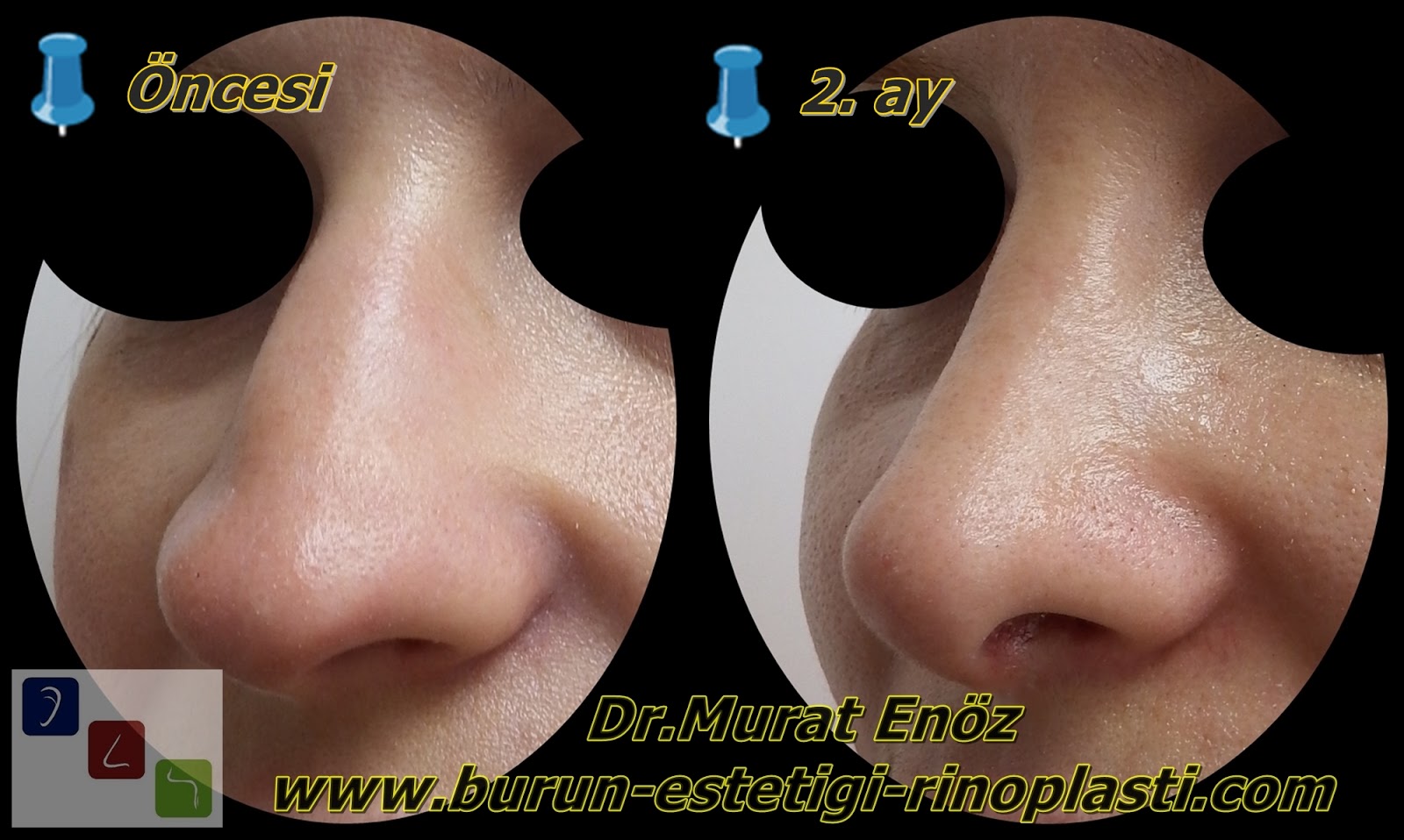 Health Zone Turkey: Nose Job in Istanbul, Turkey