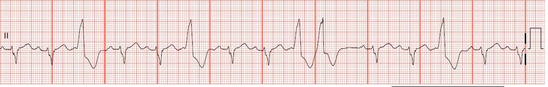 EKG Rhythm Strips 45