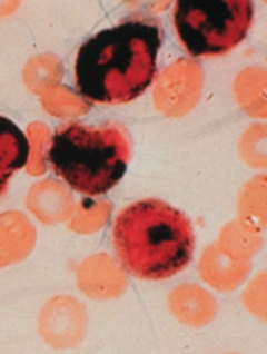 Leukemoid Reaction (LR)