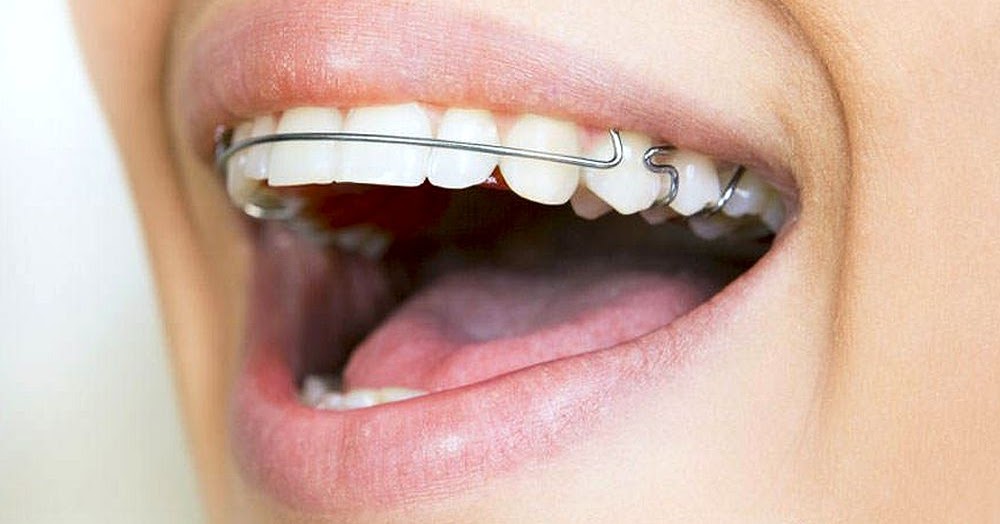 Cuidados de los retenedores de ortodoncia - Directorio Odontológico