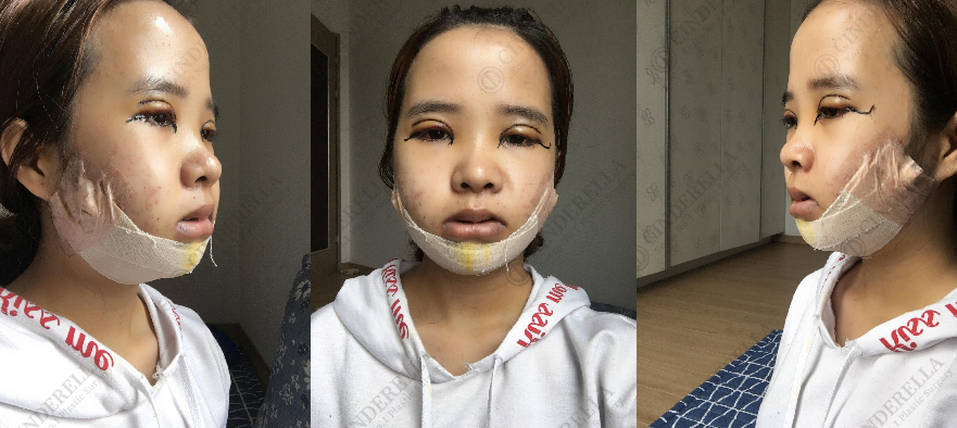 Cinderella Plastic Surgery: Cam's Real Story!