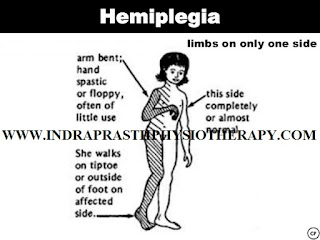INDRAPRASTH PHYSIOTHERAPY CENTRE: HEMIPLEGIA