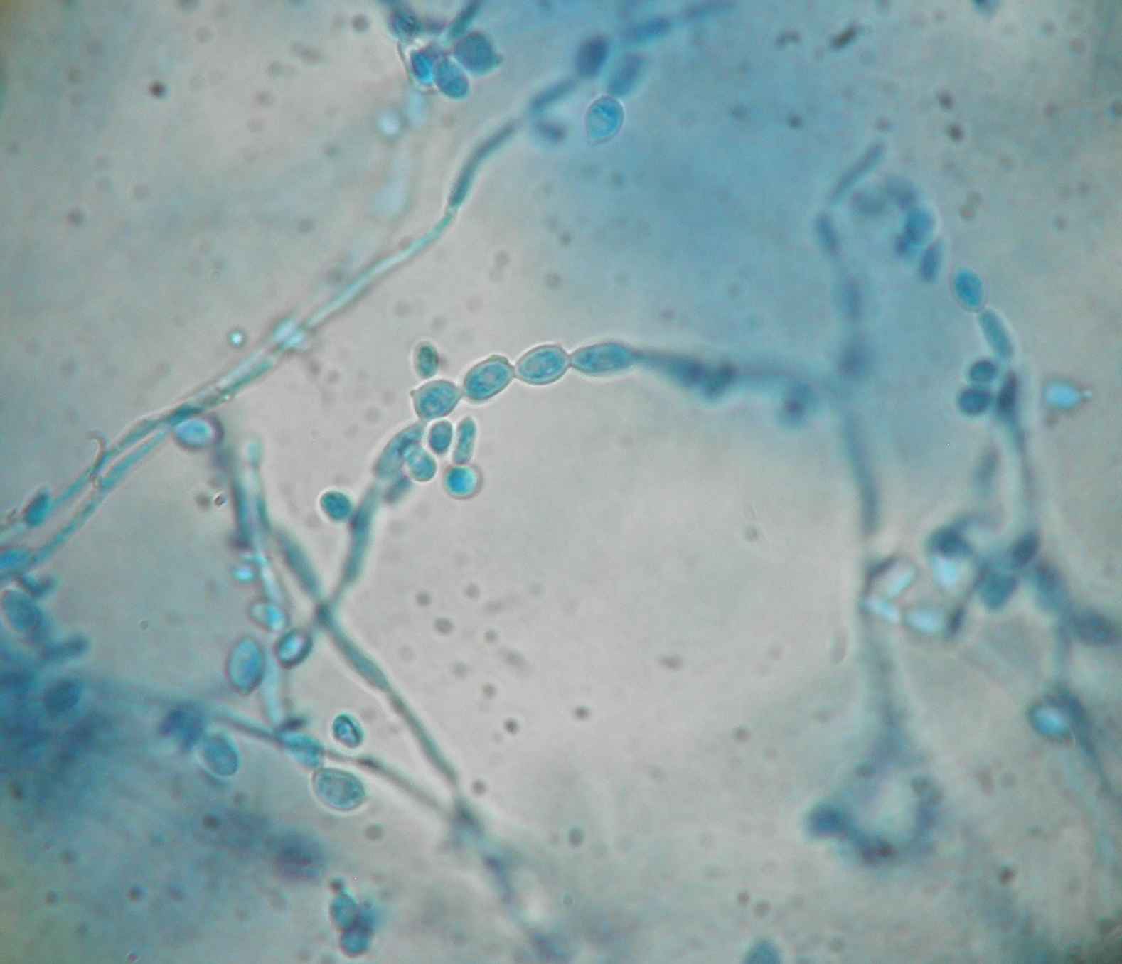 ATLAS MICOLOGIA: EXOPHIALA DERMATITIDIS