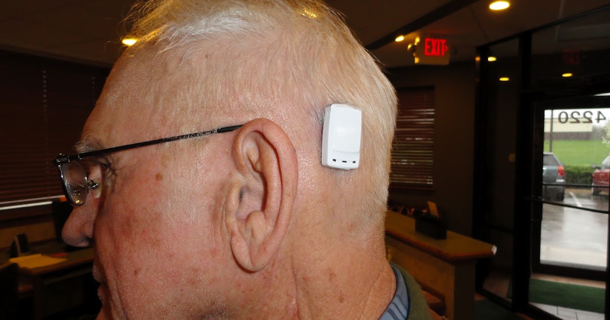 Oxford Impressions: Cochlear Baha 3 Implant