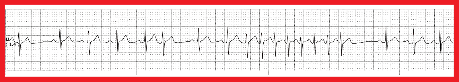 EKG Rhythm Quiz 260