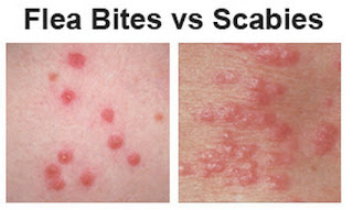 Scabies Rash Pictures | Medical Pictures and Images - (2018 Updated)