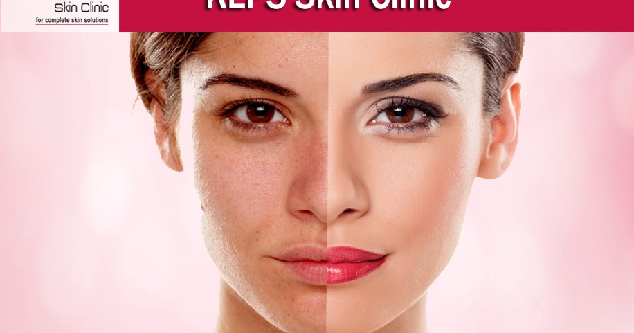 What is Skin pigmentation and how it can be treated | KEMPS Skin Clinic