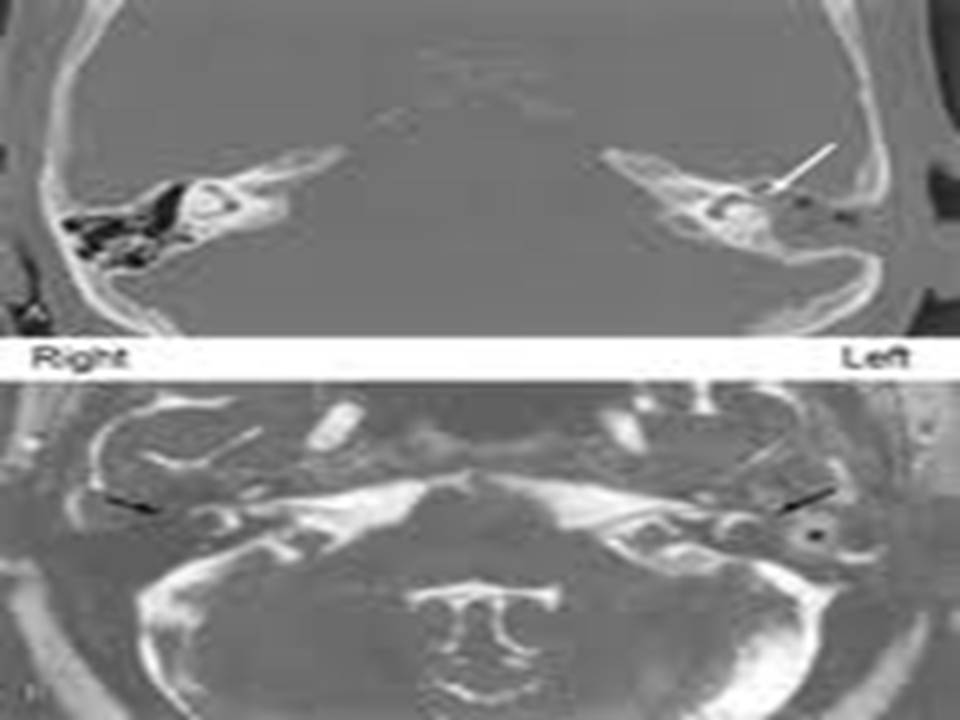 Pyothorax Without Fistula
