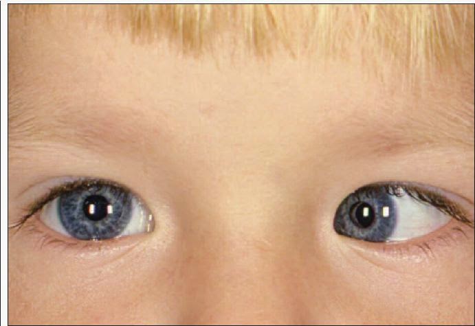 Hirschberg Testing - Eyedolatry