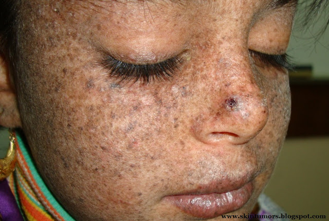 Skin Tumors: BCC in xeroderma pigmentosum