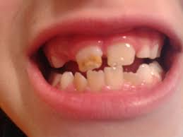 Caries rampante o caries del biberón