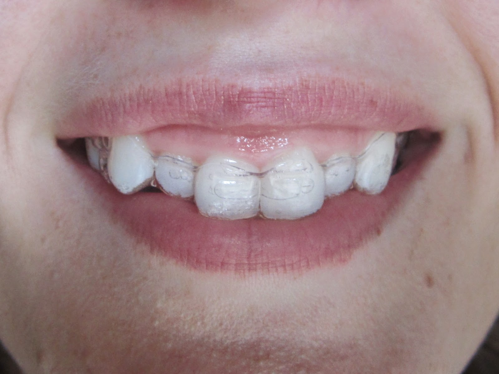 Creatively Titled Blog about Invisalign: Tray 1
