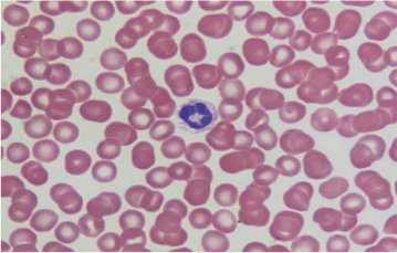 FICHERO DE HEMATOLOGIA: TROMBOCITOPENIA