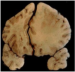 Liga de Patologia - UFC: ASTROCITOMAS