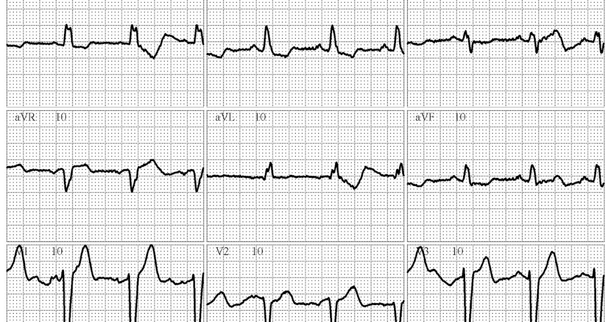 Negri Métodos Gráficos: ECG, exemplo BRE