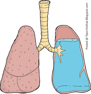 TipsInfoSihat - Maklumat Kesihatan Dan Penjagaan Diri: Paru paru Berair ...