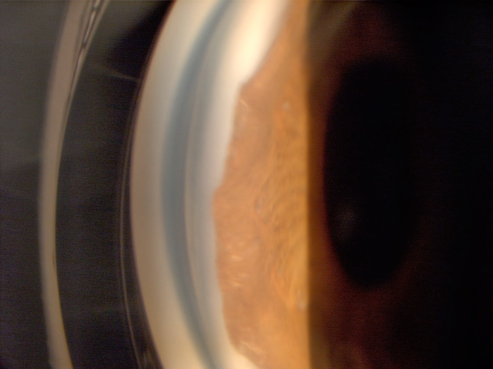 Miranza IOA: SÍNDROME DE AXENFELD-RIEGER