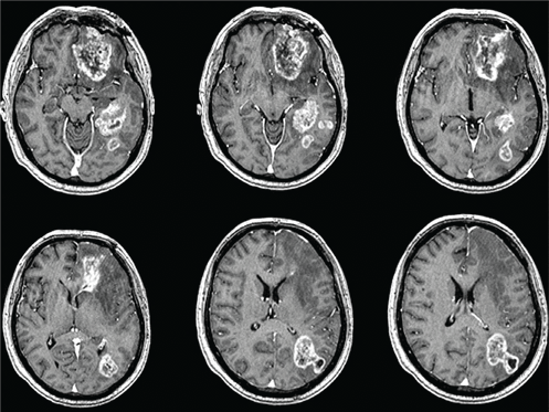 Cancer Treatment: glioblastoma symptoms and signs