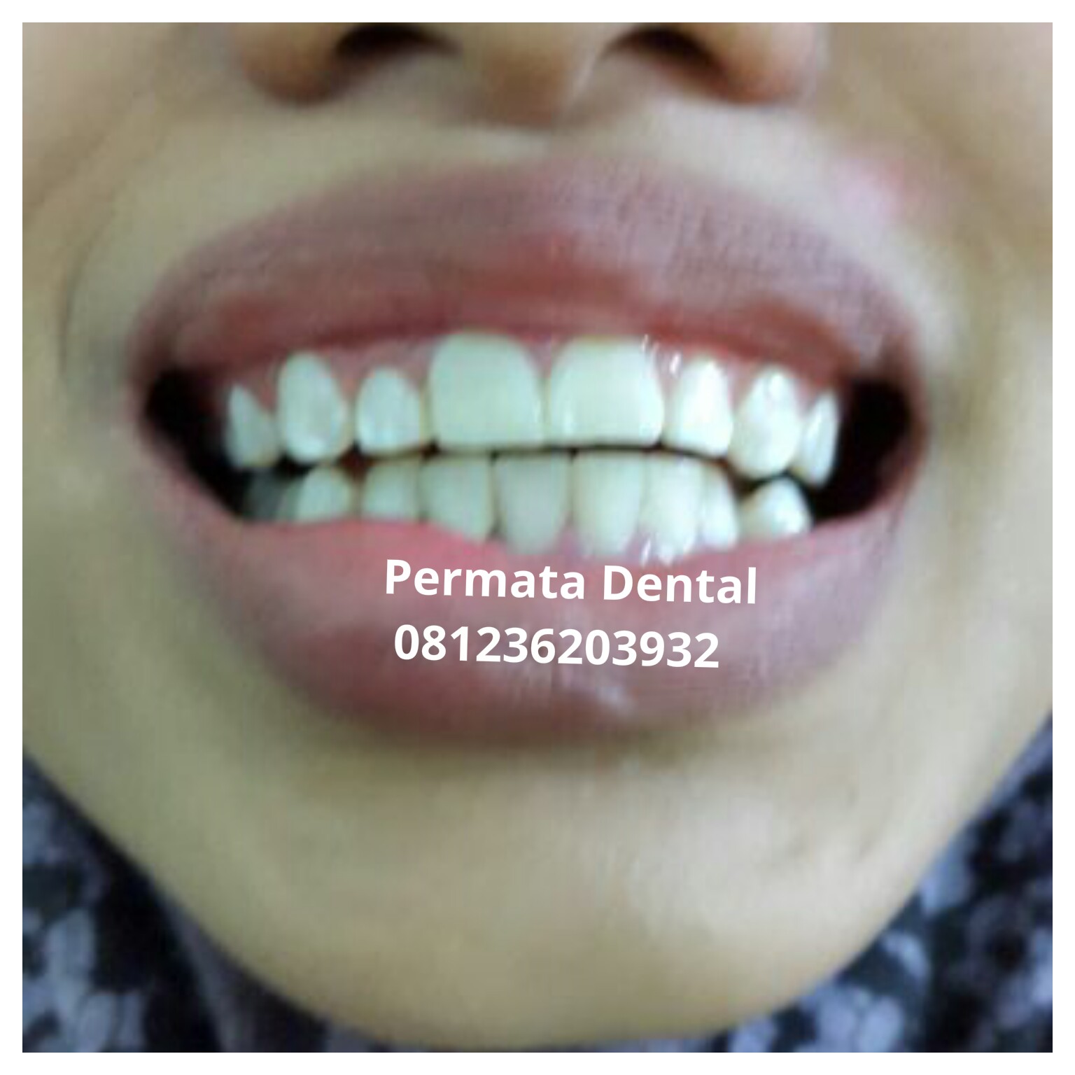 DOKTER GIGI BALI: Veneer Gigi | Samsung Gigi