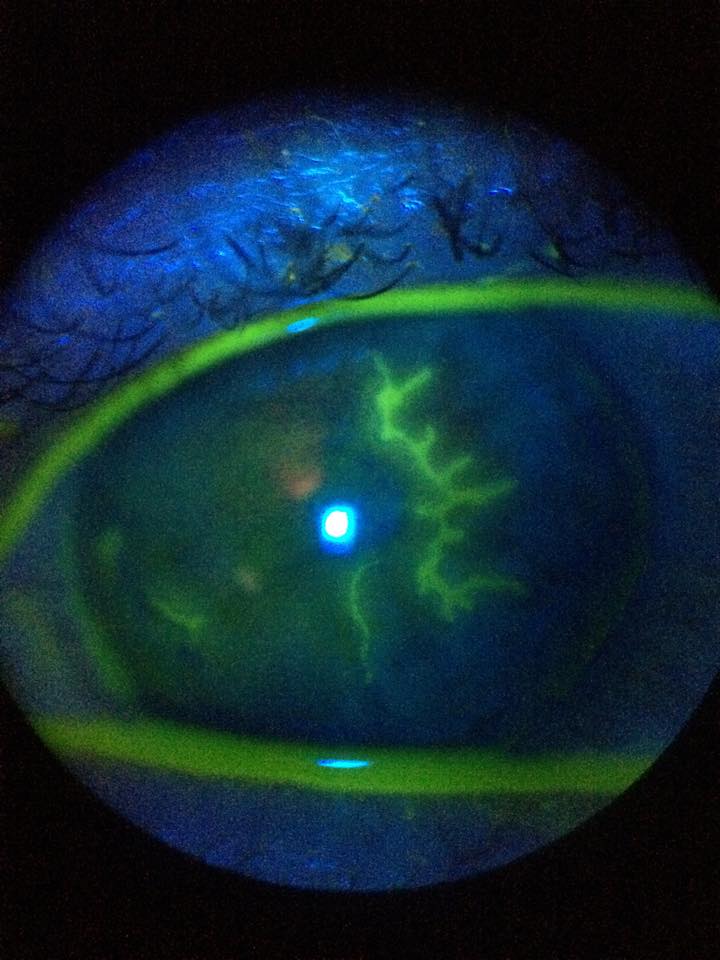 Five Things You Didn't Know About Pink Eye - Eyedolatry